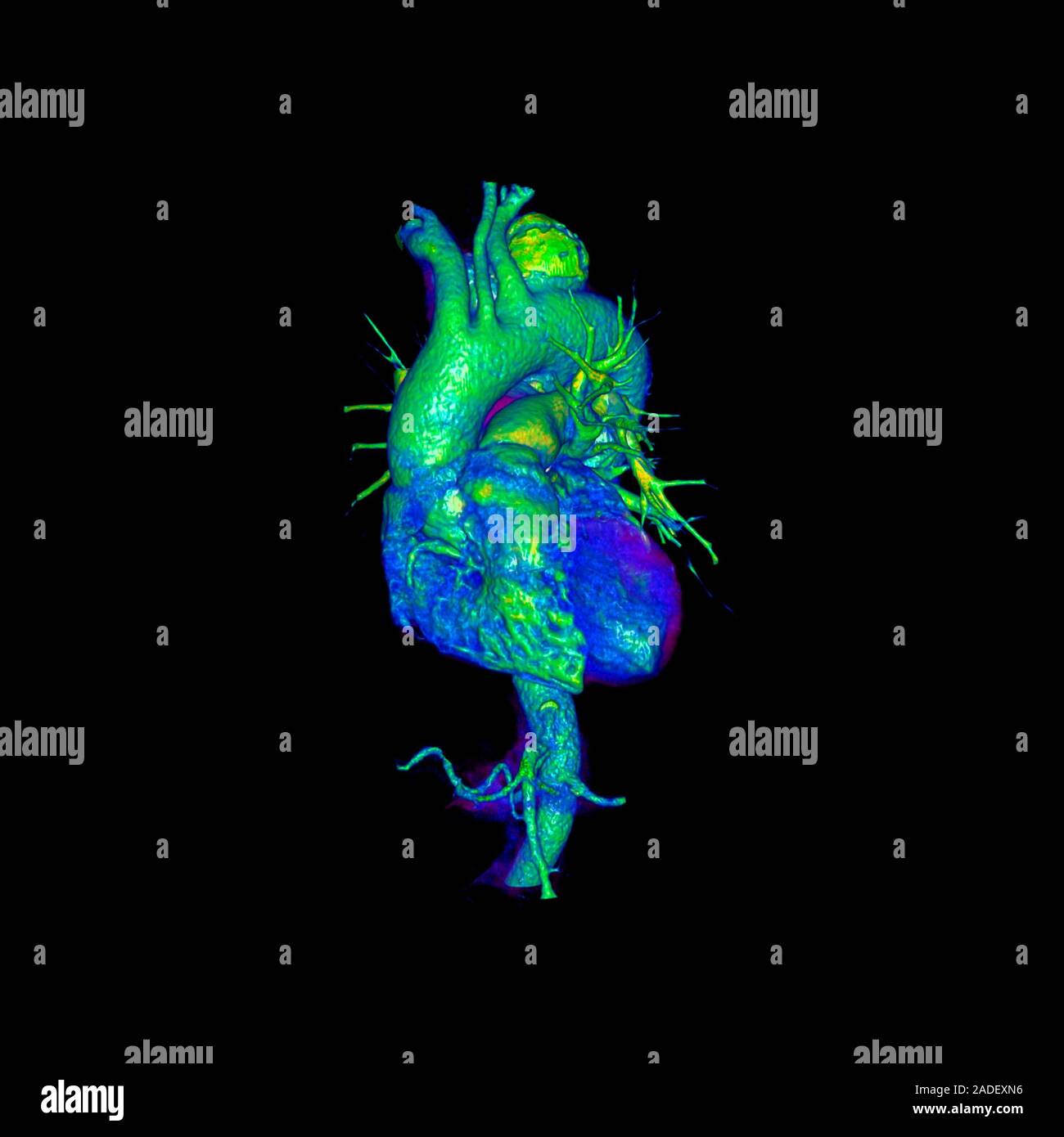 Aneurisma de la aorta. 3D tomografía axial computarizada (TAC) del ...