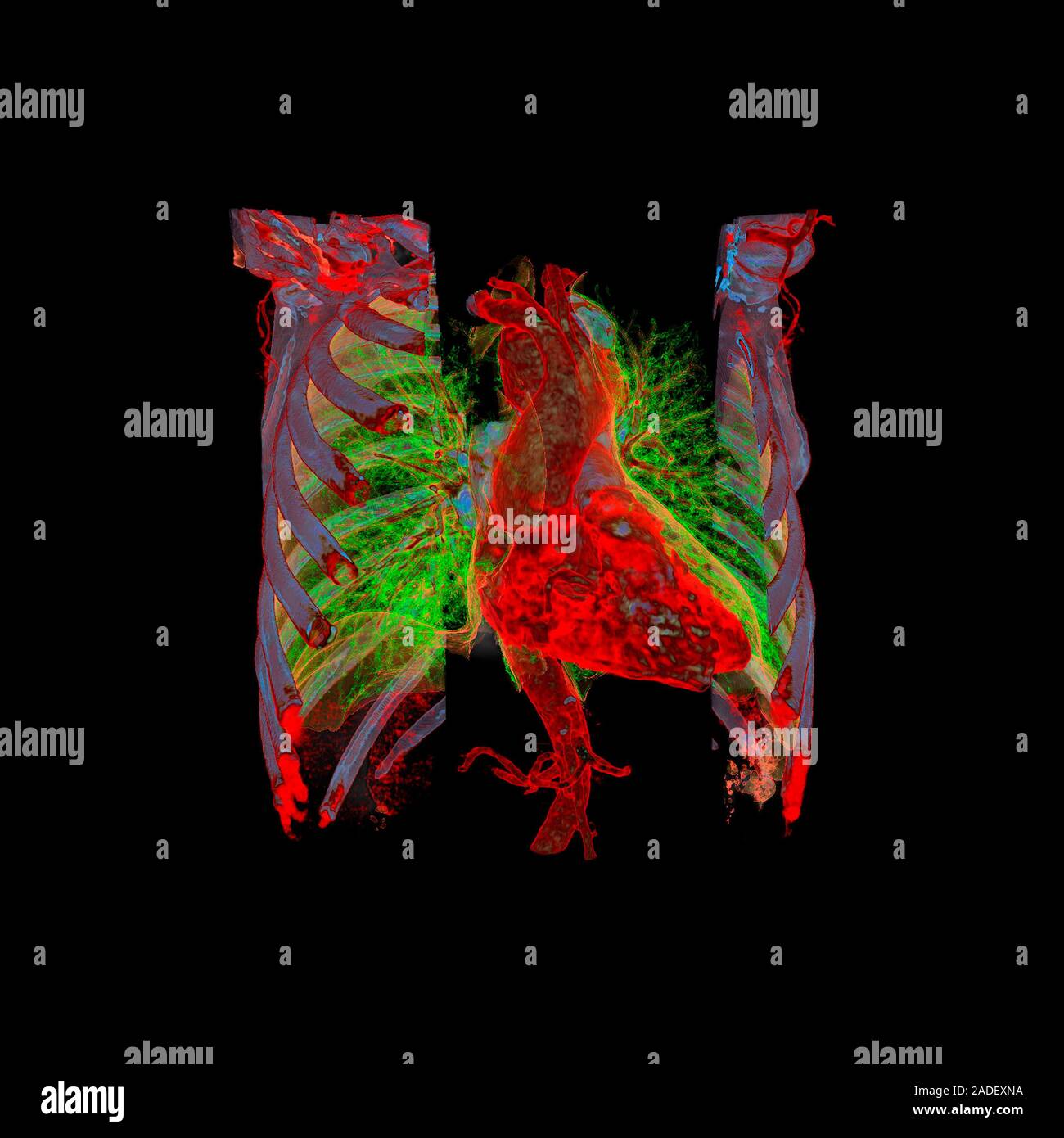 Aneurisma de la aorta. 3D tomografía axial computarizada (TAC) del ...