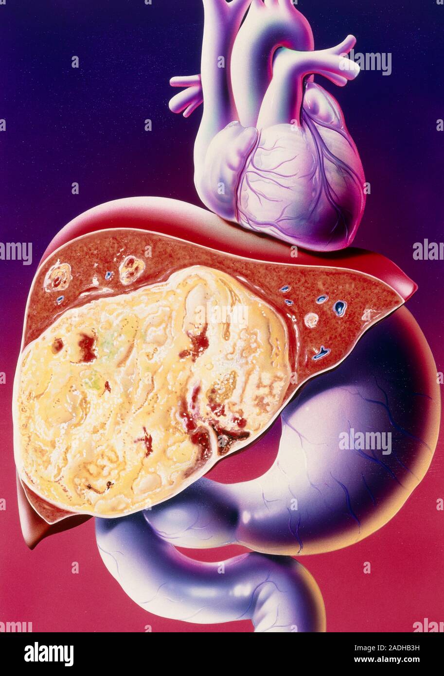 El Cáncer De Hígado Ilustración De Una Sección A Través Del Lóbulo Derecho Del Hígado Humano