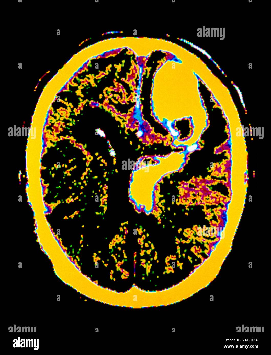 Hemorragia Cerebral Debido A Un Accidente Cerebrovascular Color