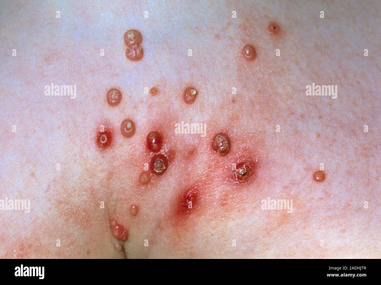 Molusco contagioso. Las lesiones llenas de pus en la piel de una niña ... Molusco contagioso. Las lesiones llenas de pus en la piel de una niña ...