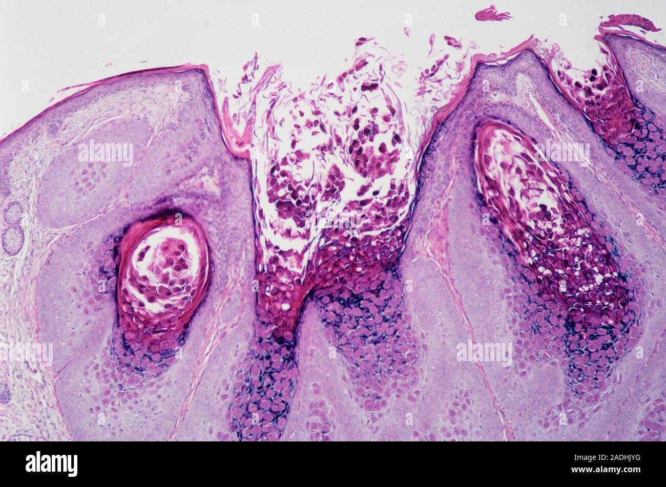 Histología Del Molusco Contagioso