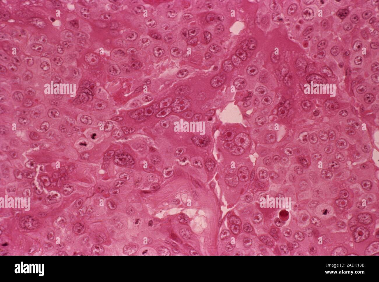 El Cáncer Testicular Micrografía De Luz De Tejido De Un Testículo En