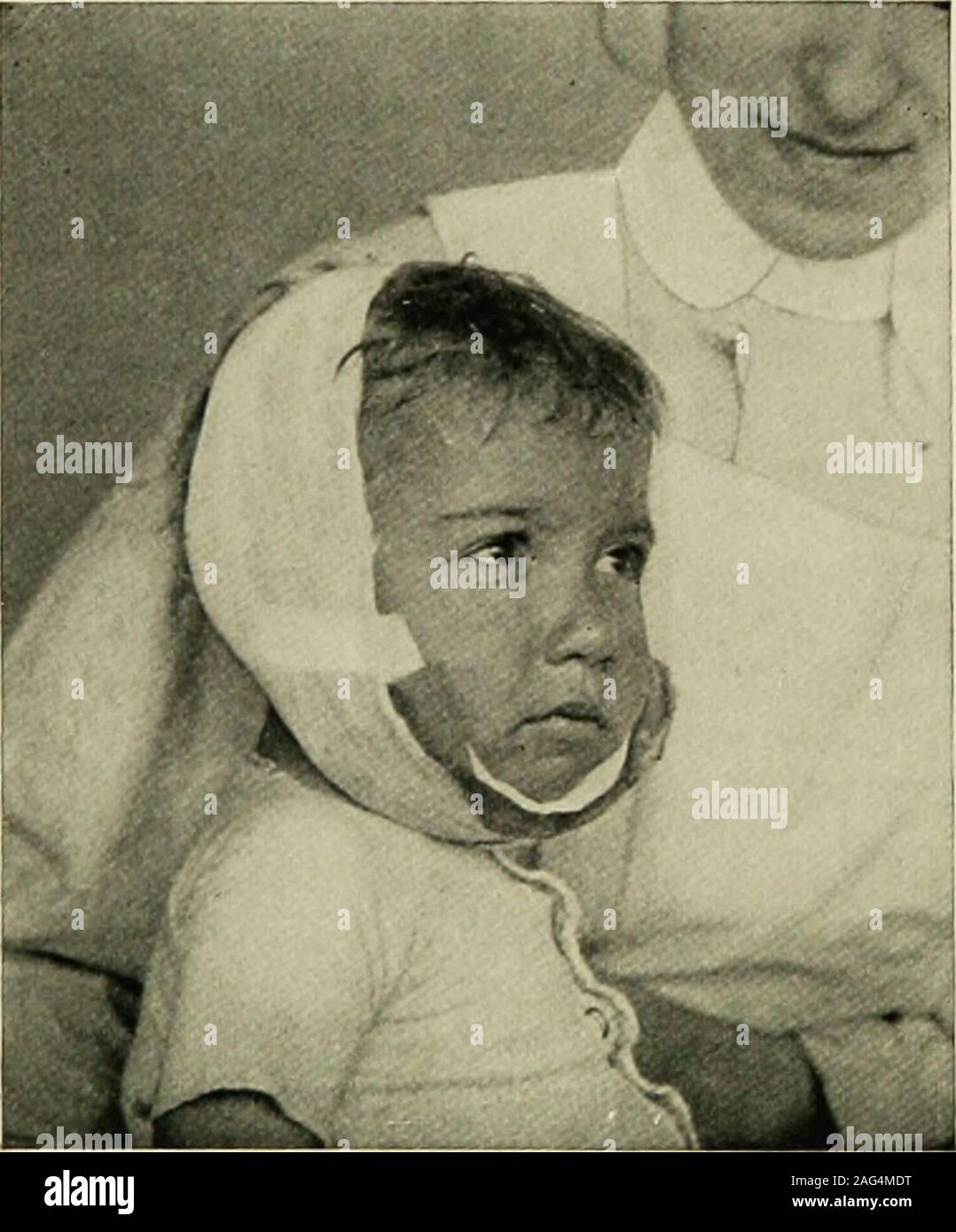 Absceso Periamigdalino