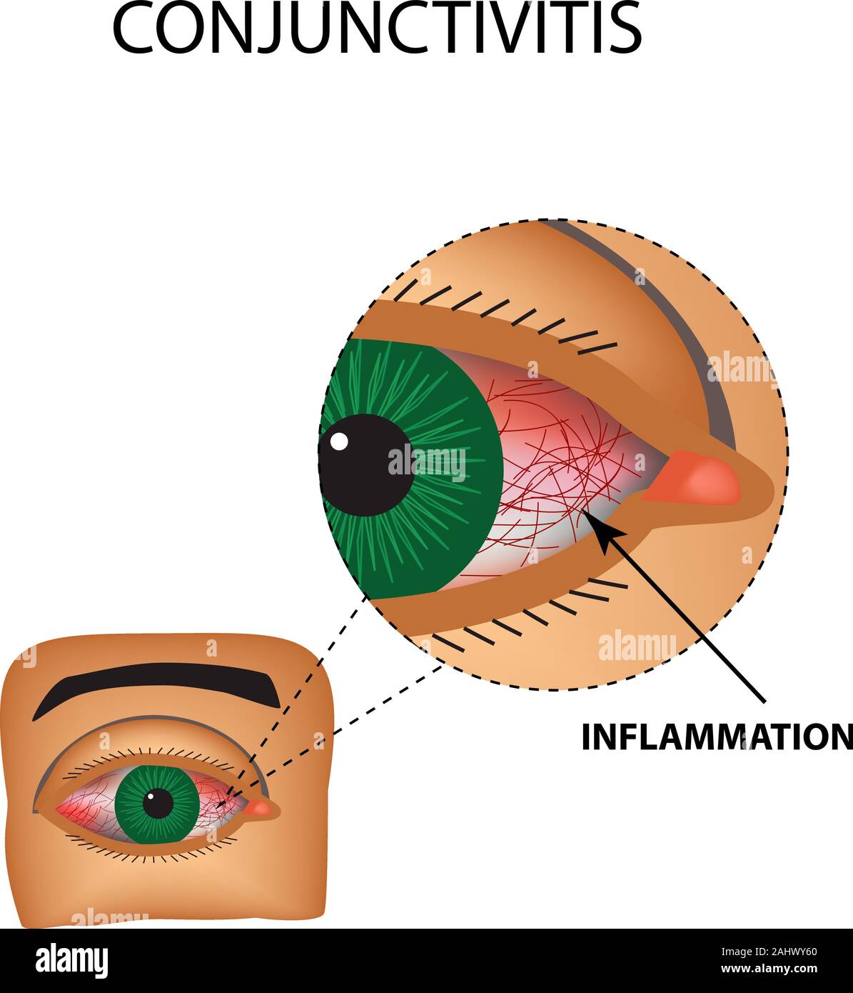Conjuntivitis Enrojecimiento E Inflamación De Los Ojos Vasos En El