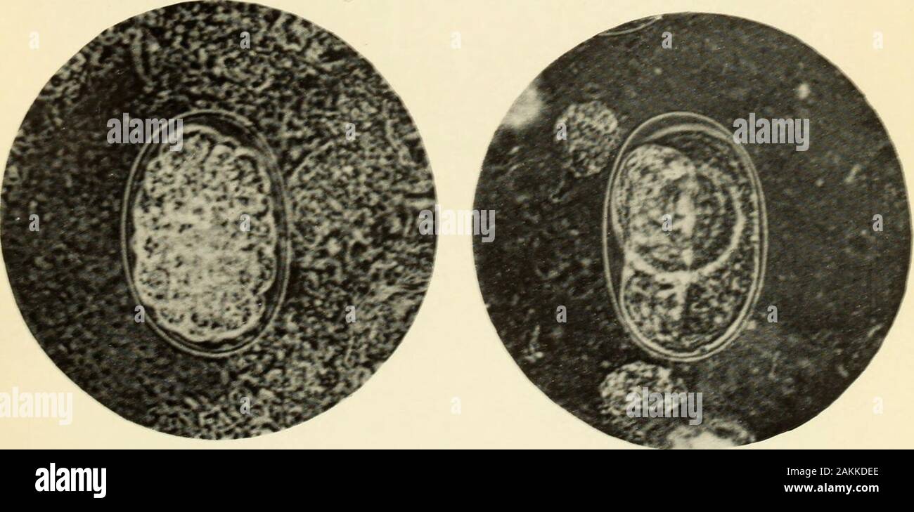 Uncinariasis O Anquilostomiasis Informacin Prctica
