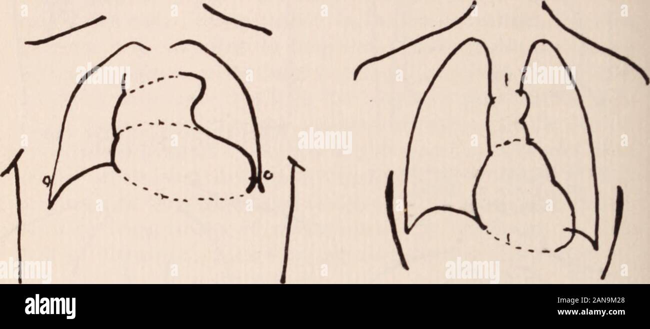 Albany Medical Anales Regurgitación Aórtica Estenosis Mitral