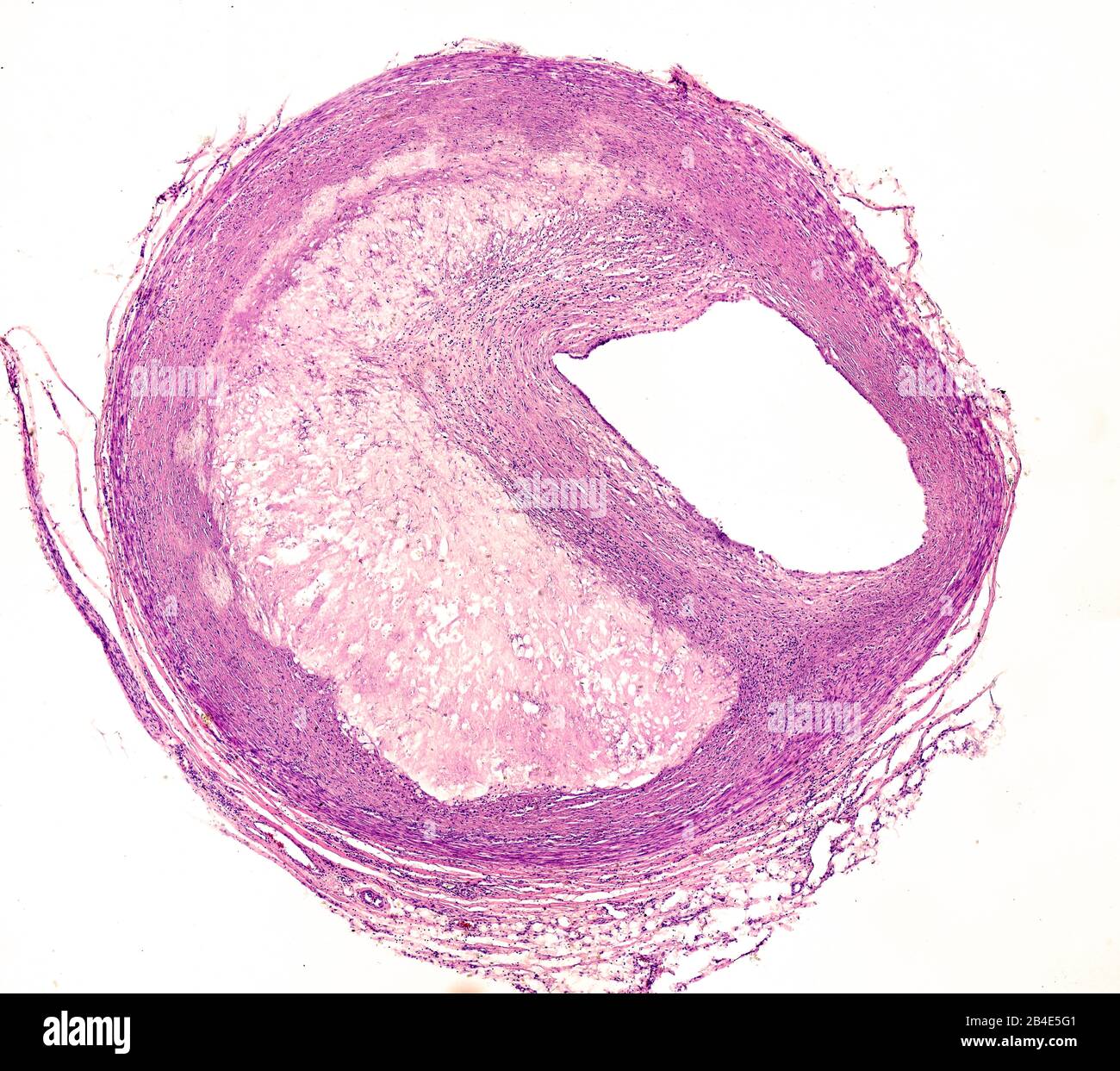 Muestra De Placa De Aterosclerosis