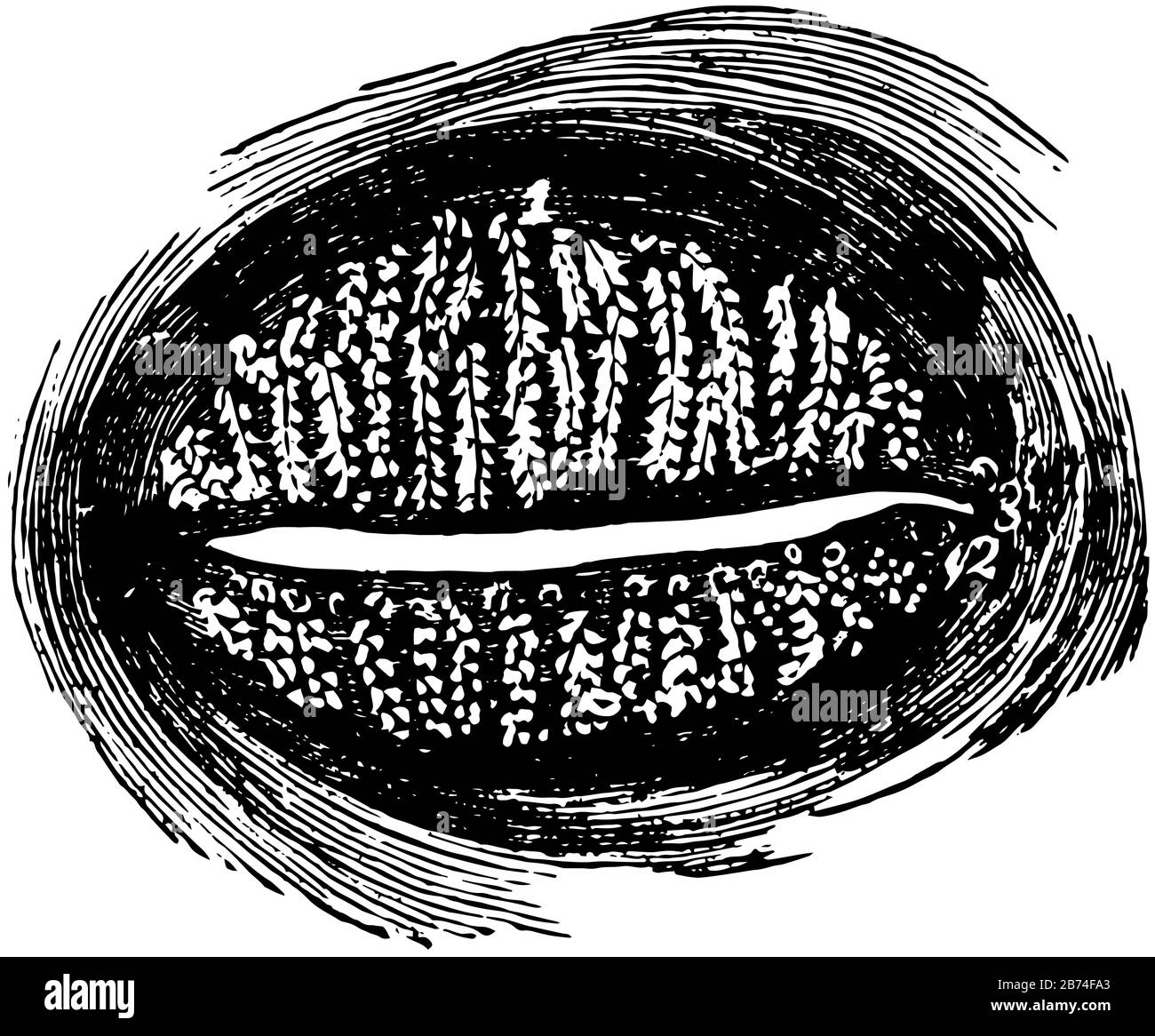 Glandulas De Meibomio