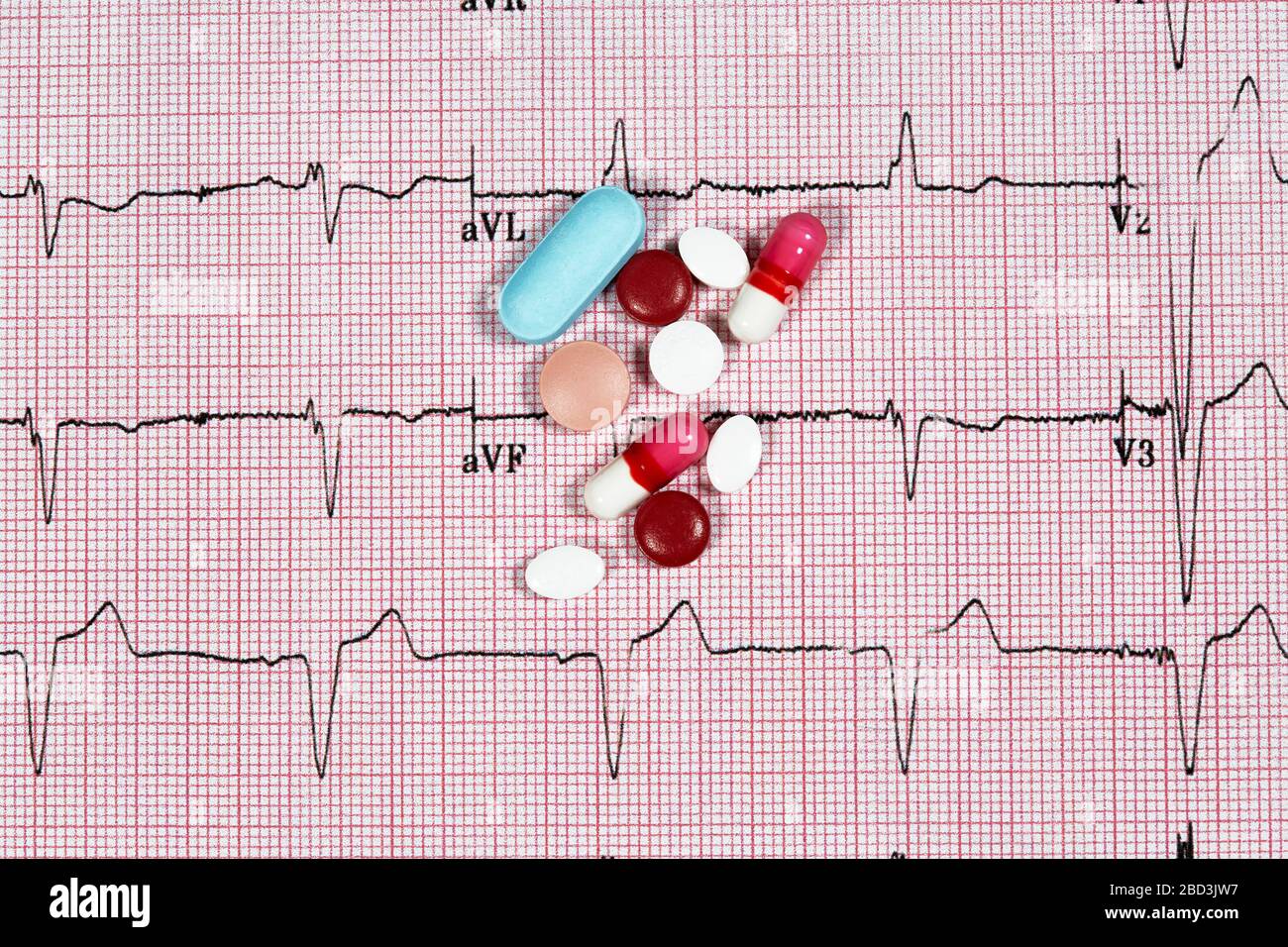 Informe de prueba ecocardiográfico (ECG) de primer plano que muestra un ...