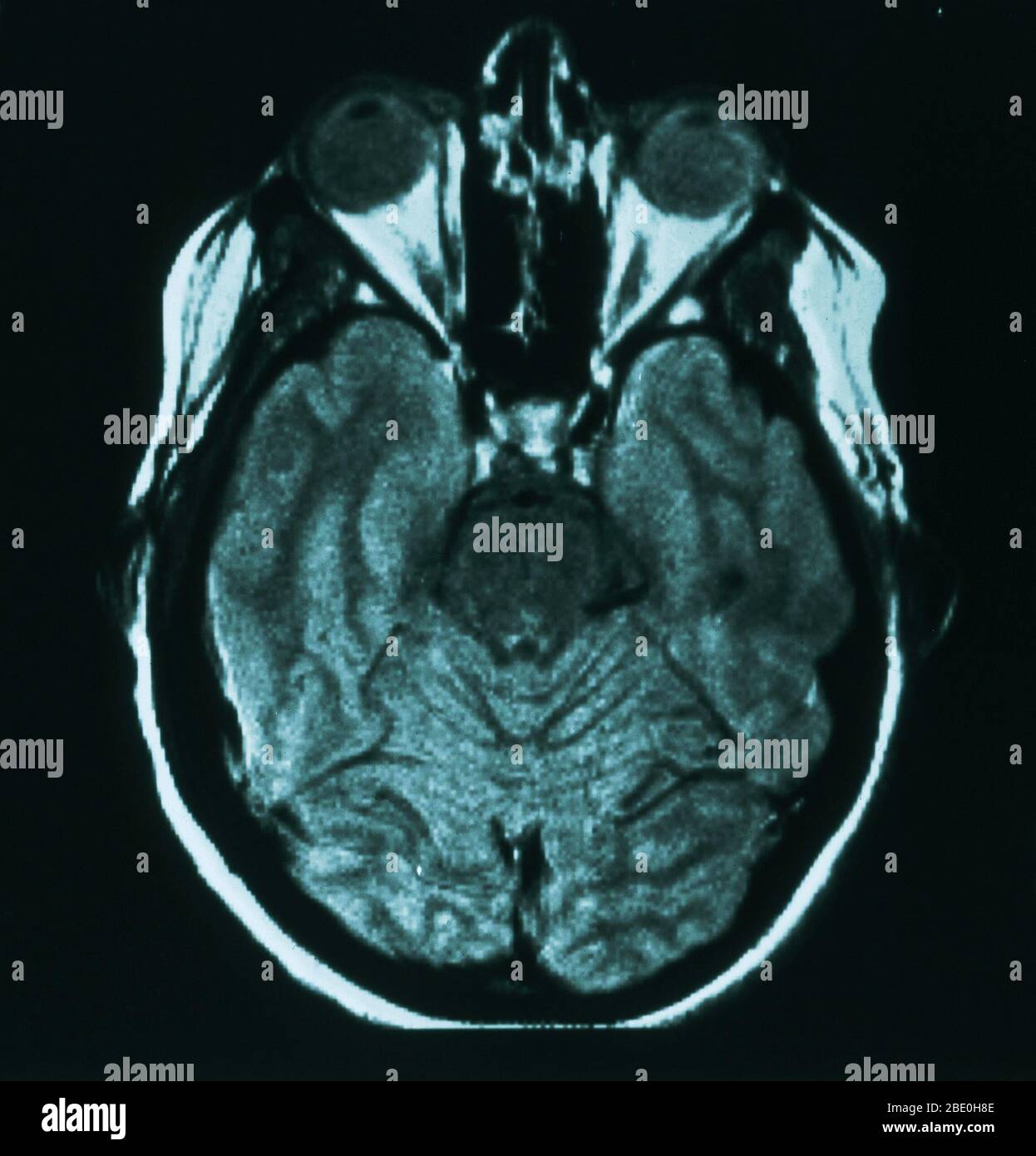 Resonancia Magnética De La Anatomía Del Cerebro