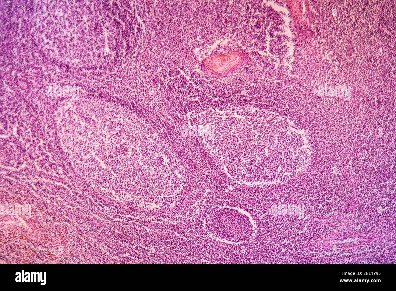 Histología De Las Amígdalas Faríngeas
