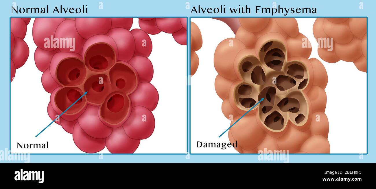 Alvéolos En Enfermedades Pulmonares Ilustración Del, 54% OFF