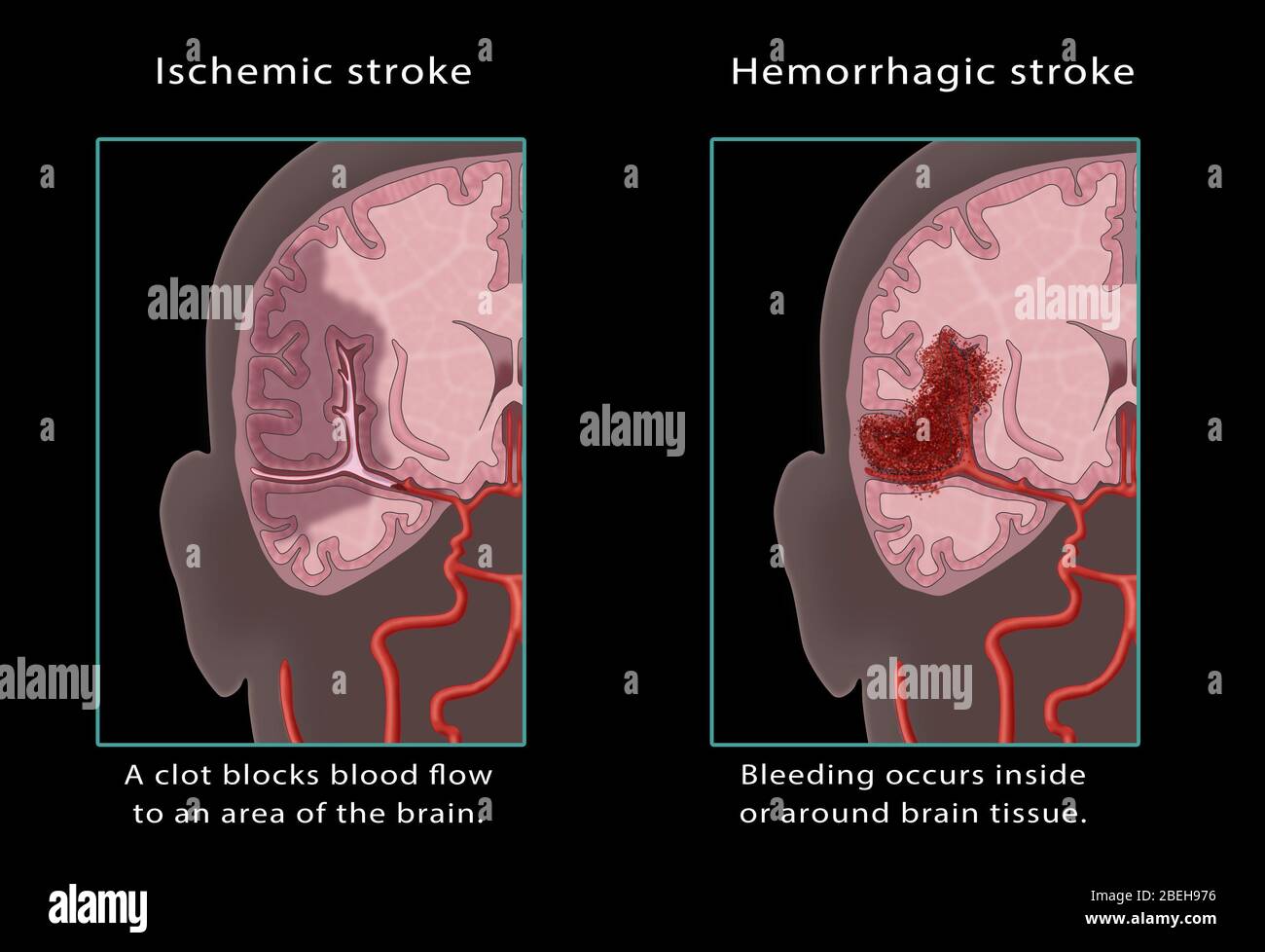 Ressonancia Magnetica De Acidente Vascular Cerebral Isquemico Vs ...