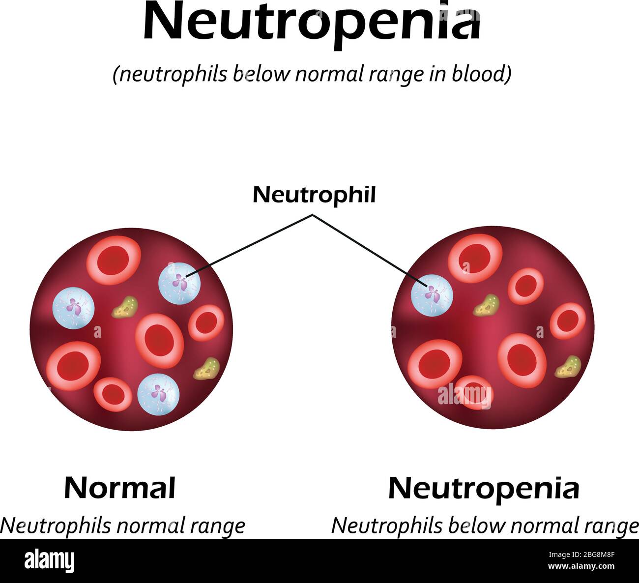Pequenos Números De Neutrófilos - ZULEDU