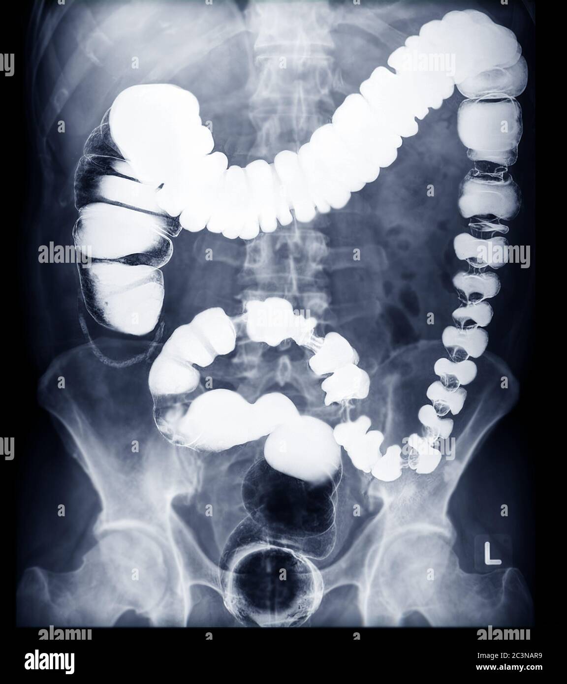 Barium Enema Fotografías E Imágenes De Alta Resolución Alamy