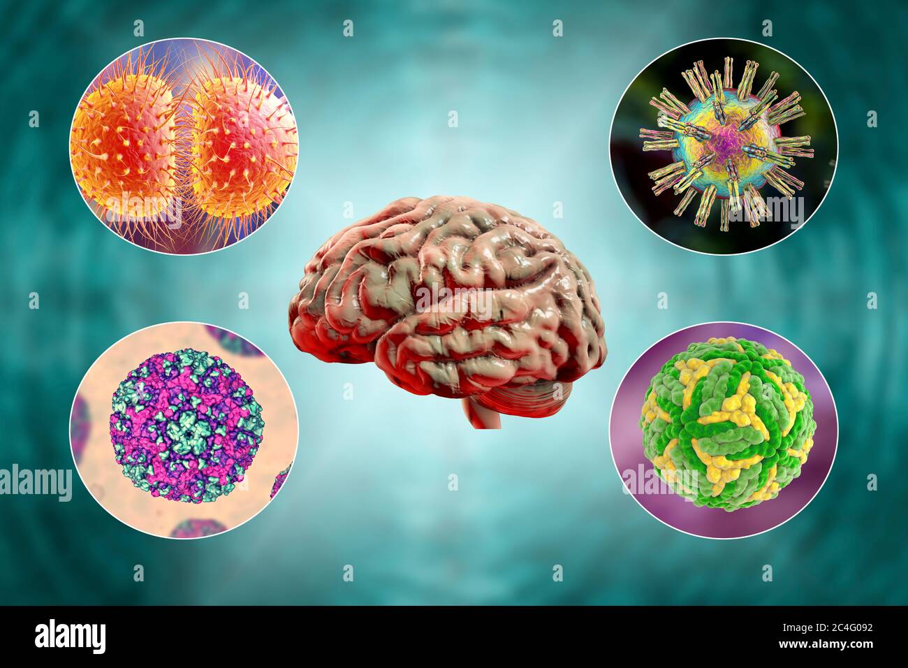 Infecciones Cerebrales