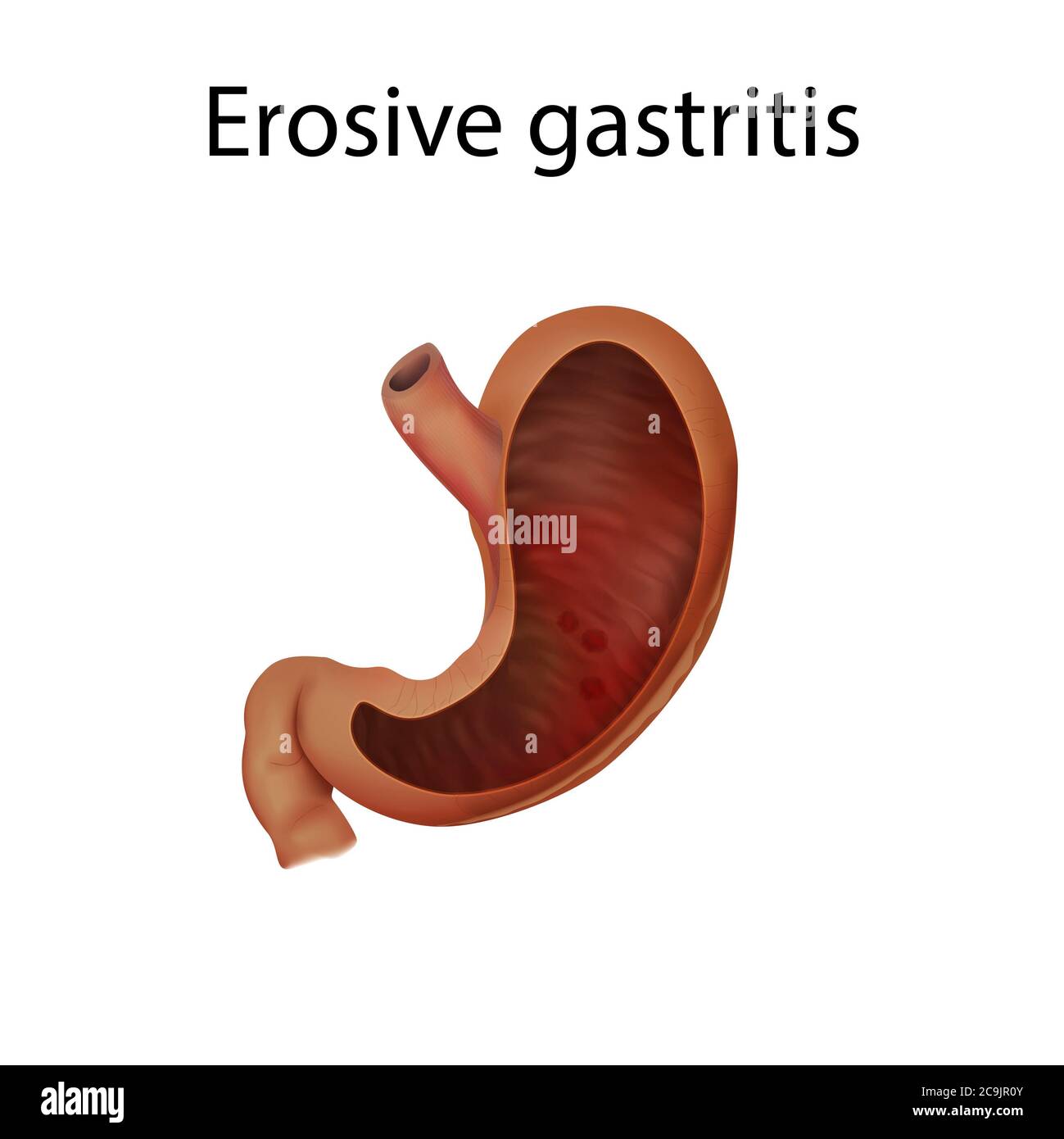 Gastrite Erosiva é Perigosa - BRAINCP