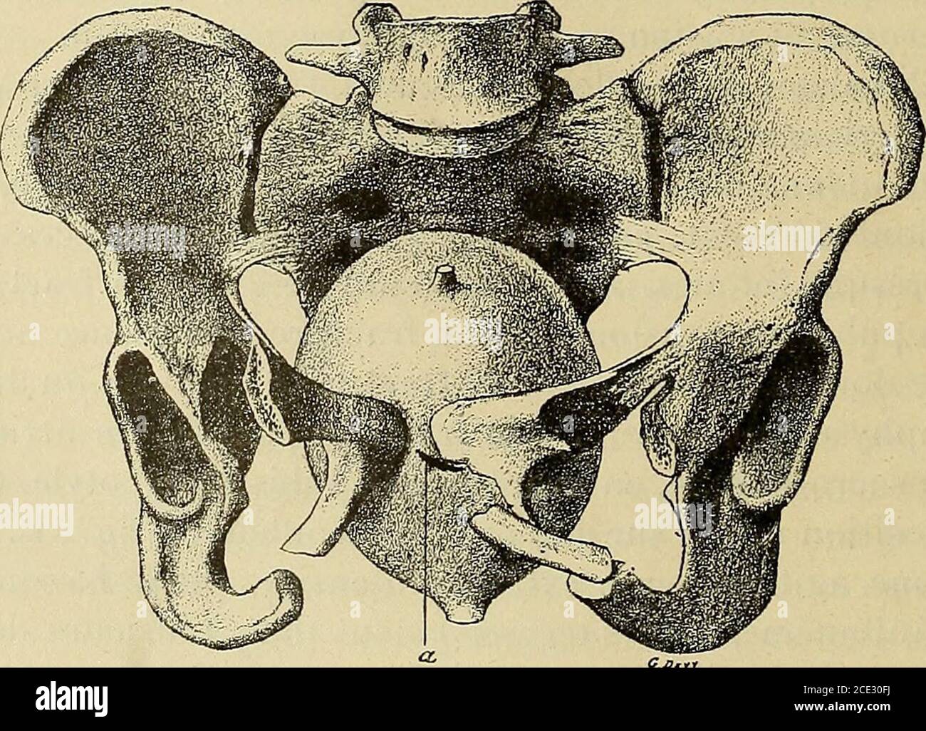 . Traité de chirurgie clinique et opératoire . Fig. 34. — Fracture du ...