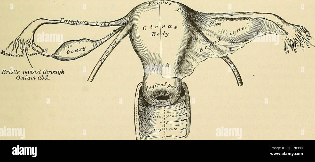 Infundíbulo Ligamento Pélvico