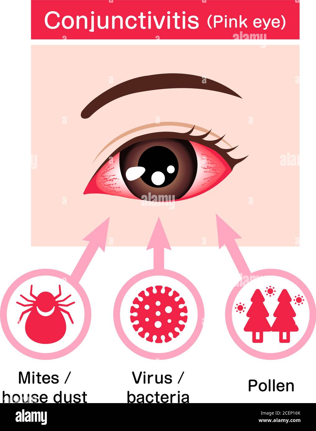 Causas De La Conjuntivitis Ojo Rosado Ilustración Vectorial Imagen