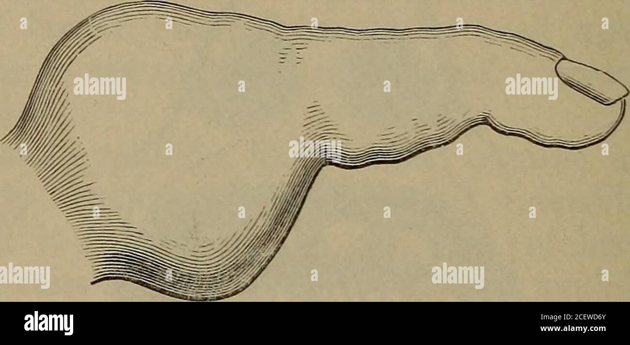 Enfermedades En El Escroto Imagen