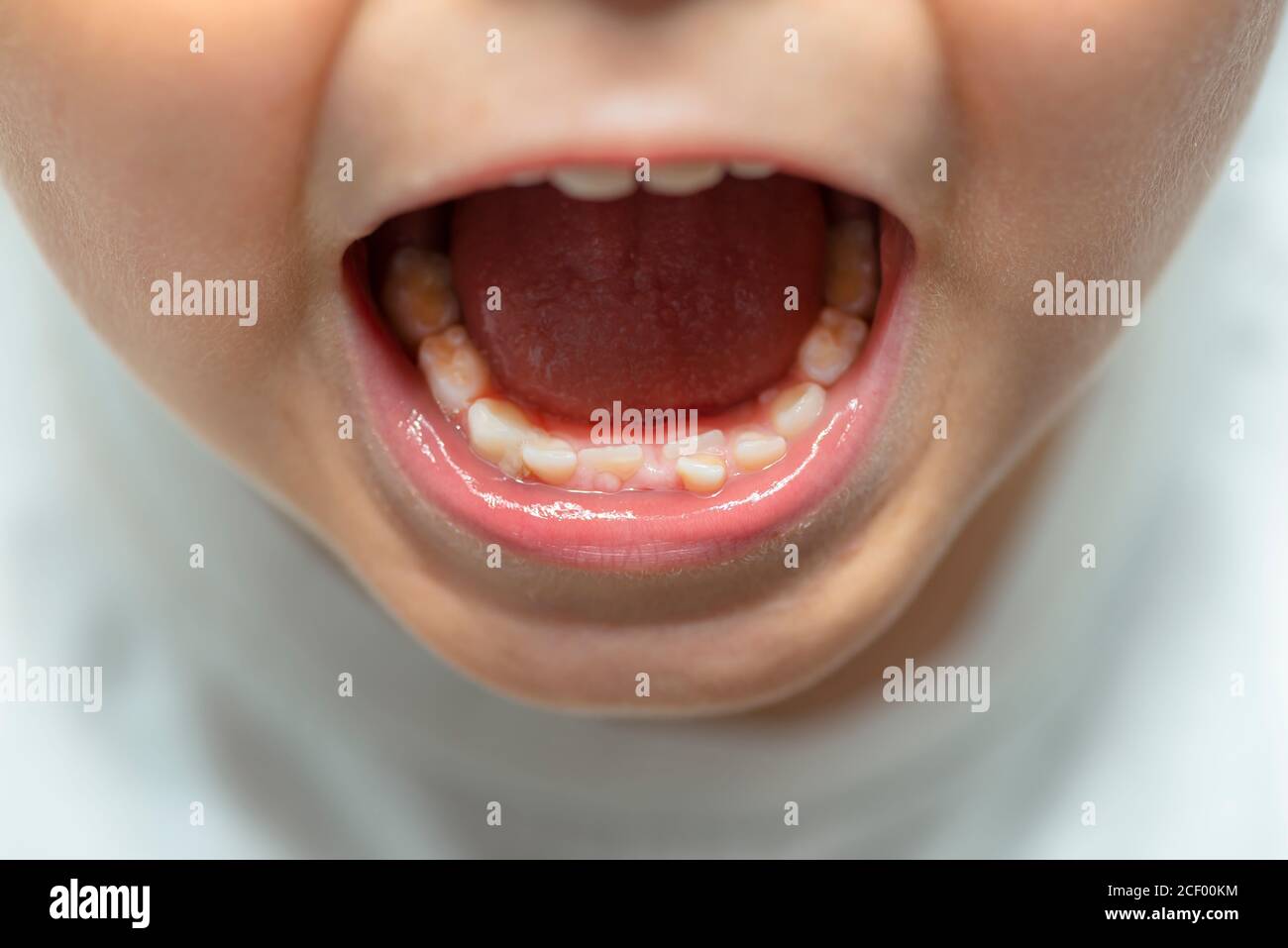 Dientes Boca Abierta
