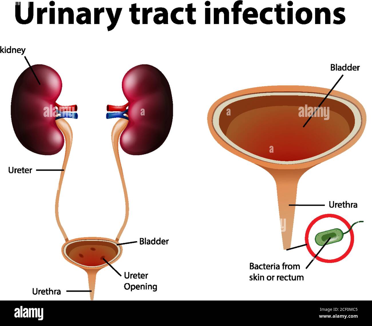 Ilustración Informativa De Infecciones Del Tracto Urinario Imagen