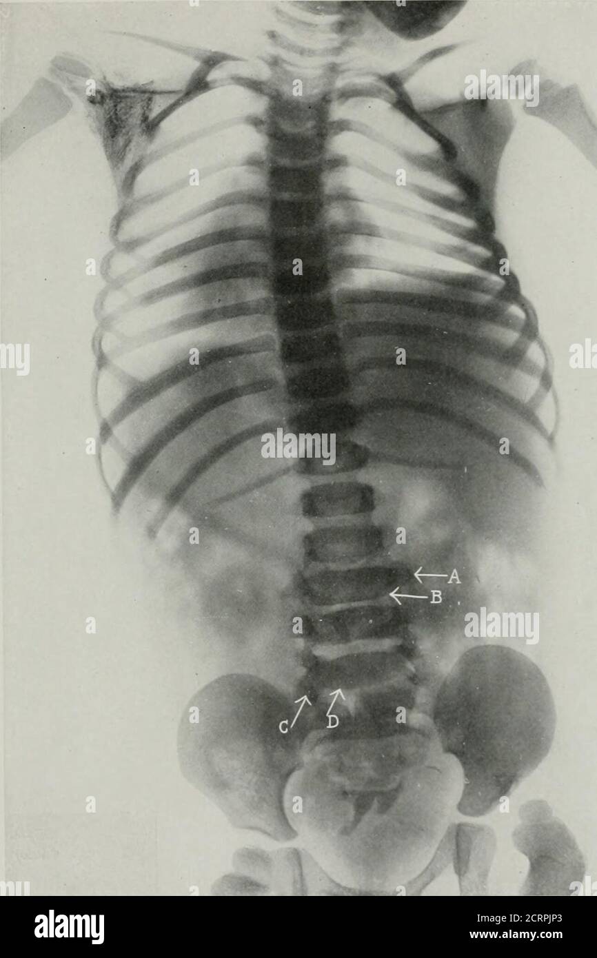Espina Bífida Oculta Rayos X