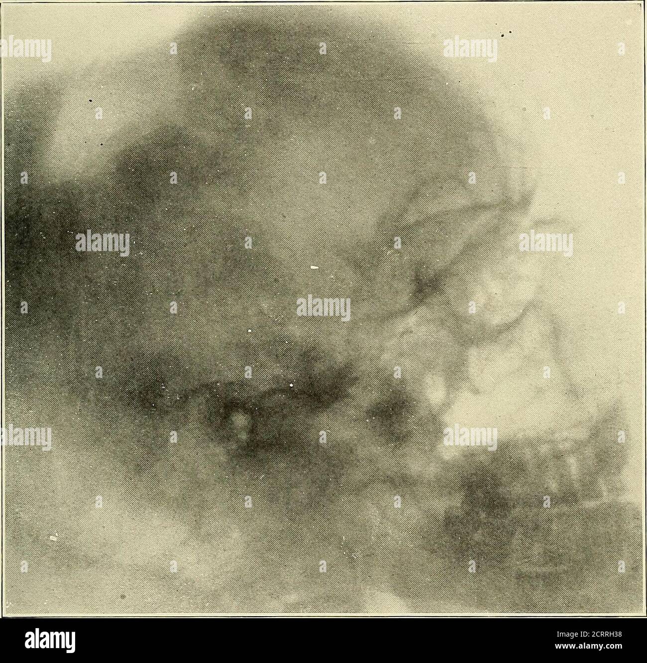 Radiografia De Sutura Lambdoide