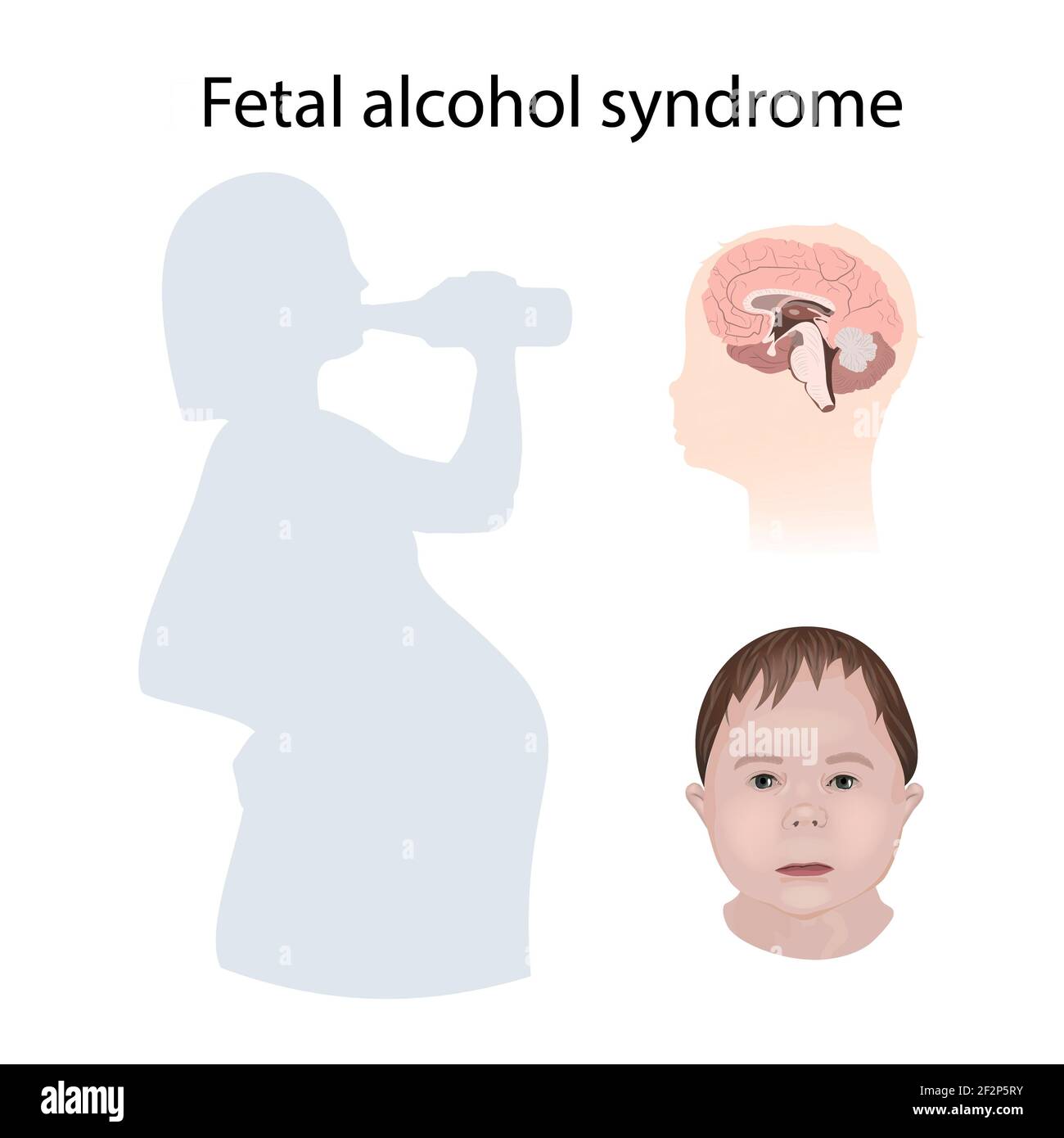 Síndrome De Alcohol Fetal Imágenes Recortadas De Stock Alamy