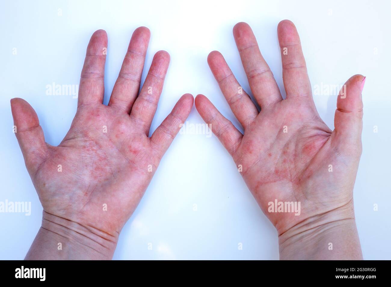 Problema Dermatologico Fotos e Imágenes de stock - Alamy