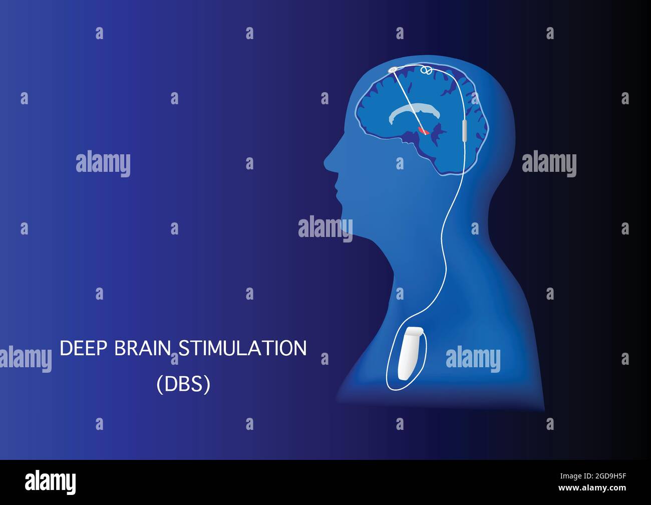 Neuromodulación Con Estimulación Cerebral Profunda O Dbs Para El