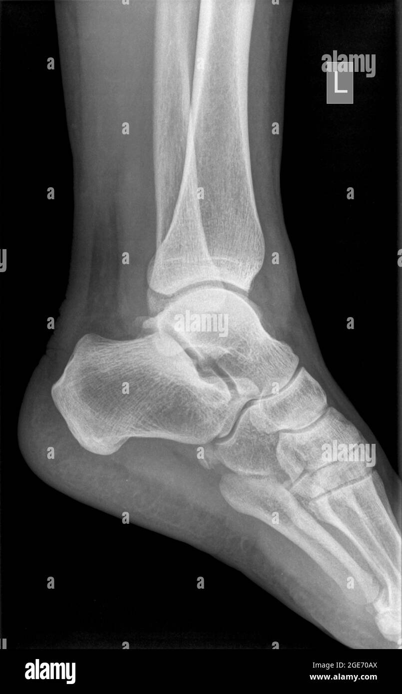 Radiografiadetobilloroto