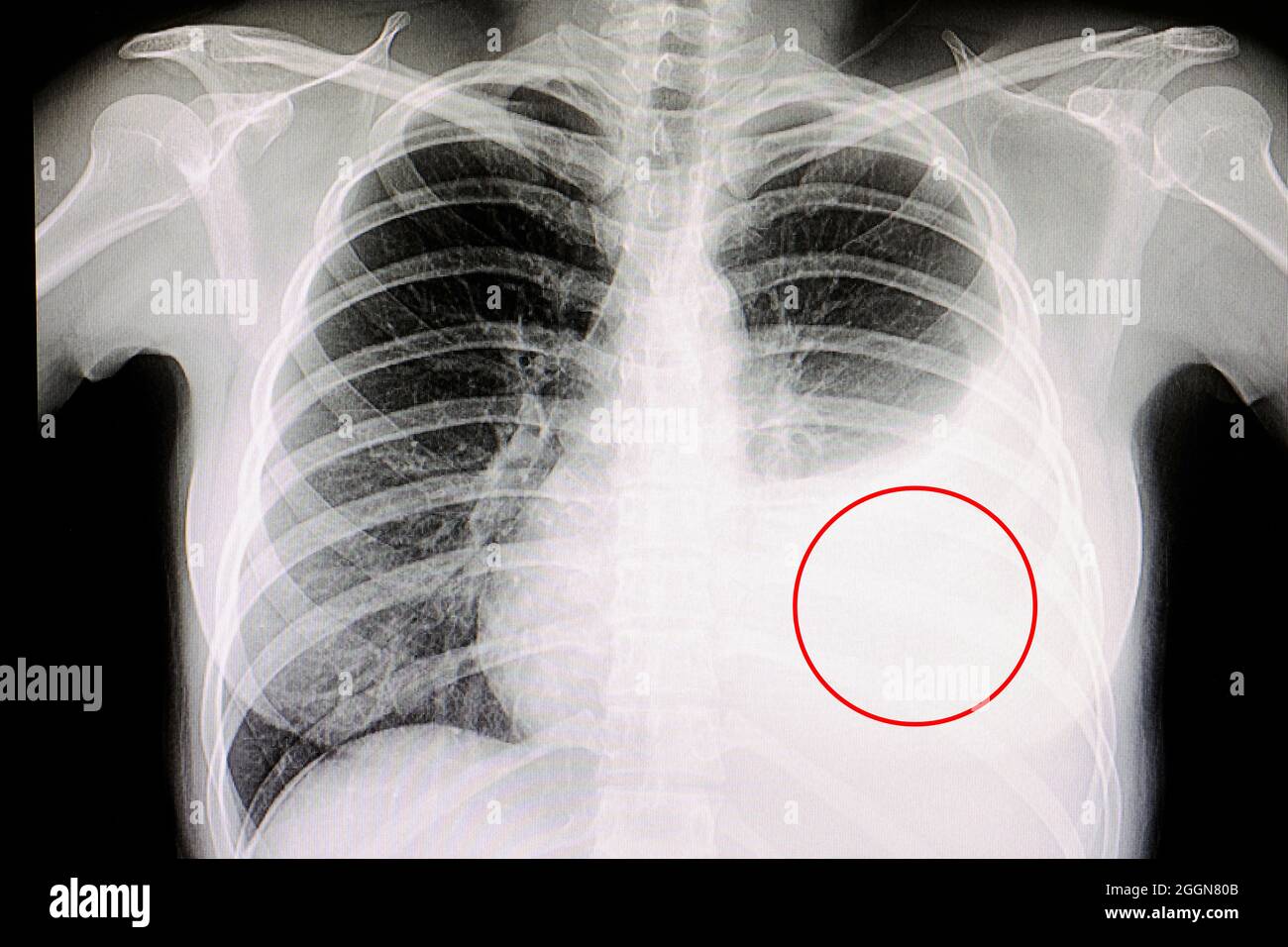 Raio X Com Derrame Pleural - RETOEDU
