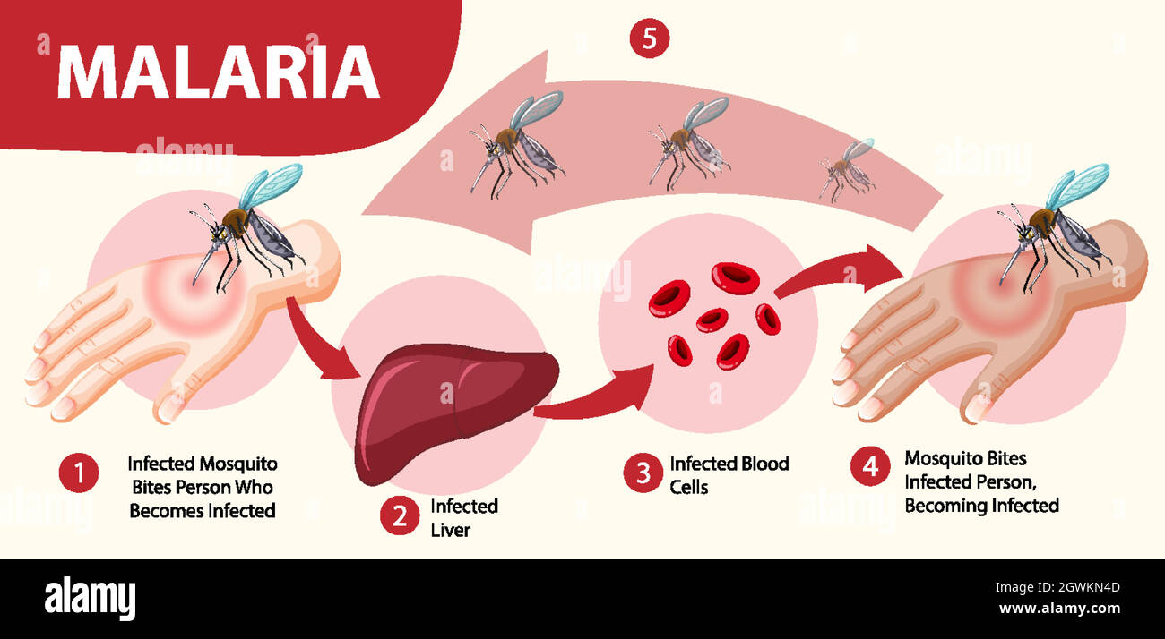 Infografía De Información Sobre Síntomas De Malaria Imagen Vector De