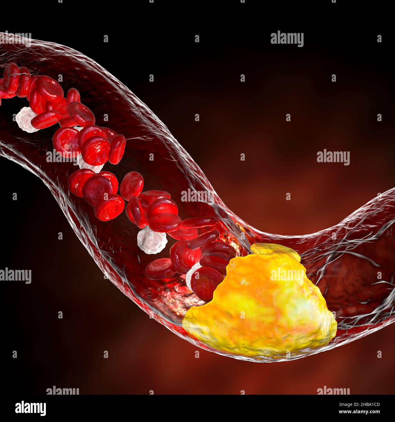 Muestra De Placa De Aterosclerosis