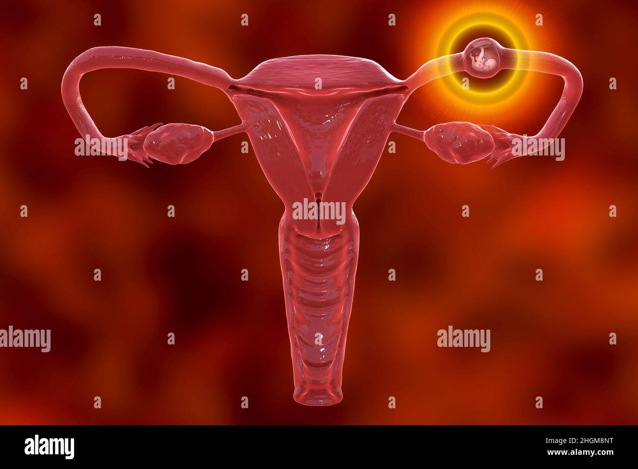Embarazo Ectópico Ilustración Fotografía De Stock Alamy