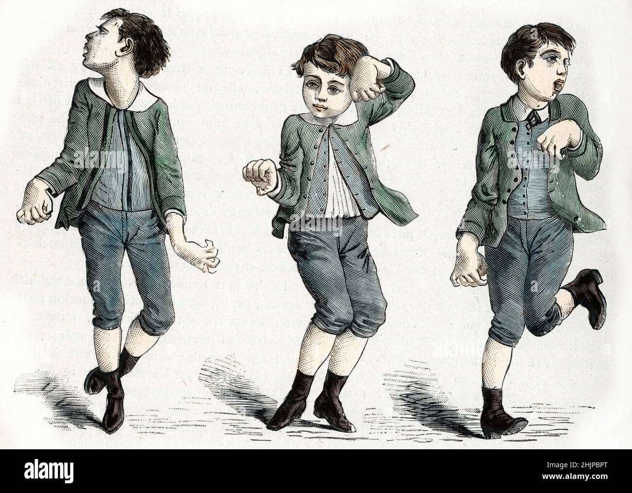 Corea Fiebre Reumática