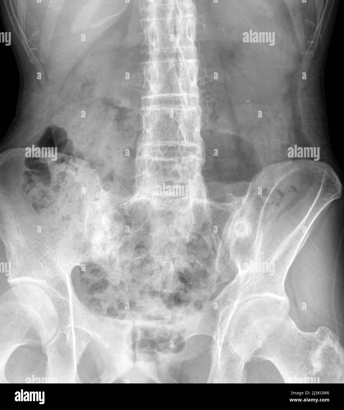 Radiografía De Espondilitis Anquilosante Cervical