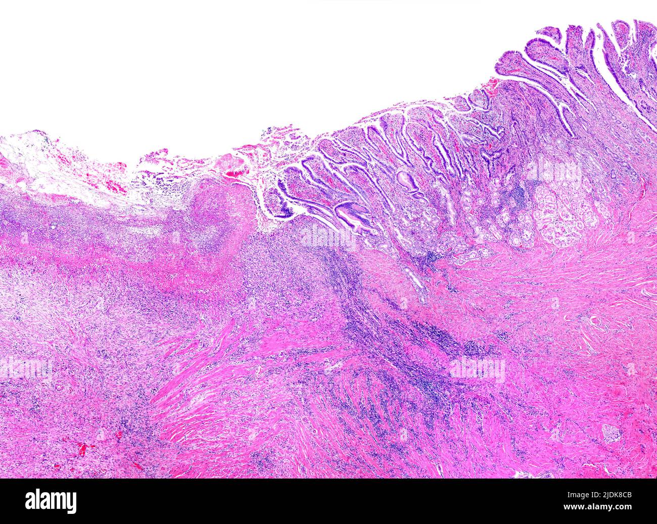 Histología De La úlcera Gástrica