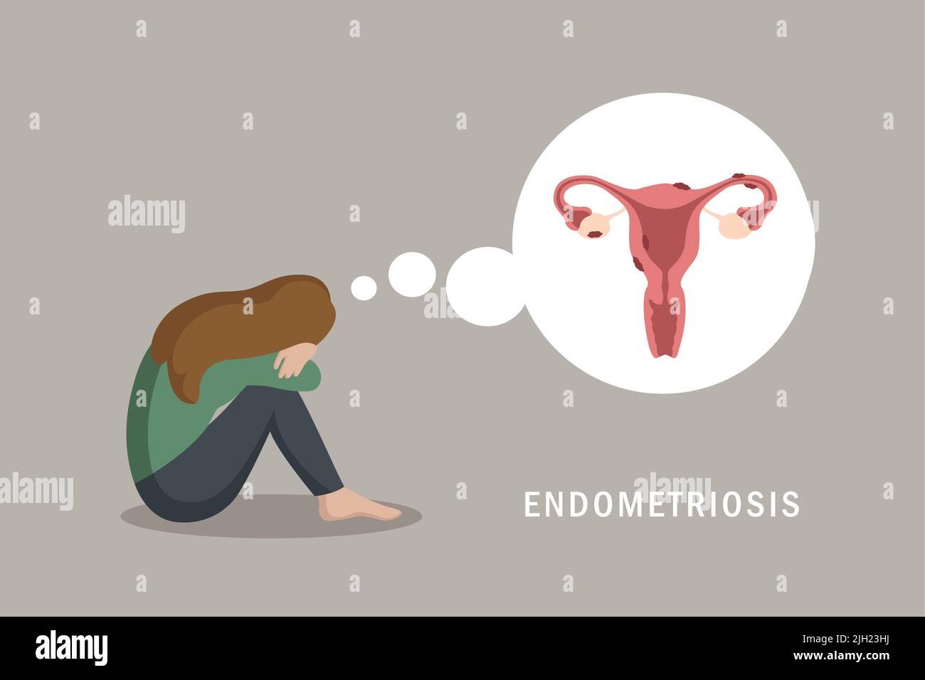 Endometriosis Y útero Normal Mujer Salud Anatomía Gráfico Info Imagen