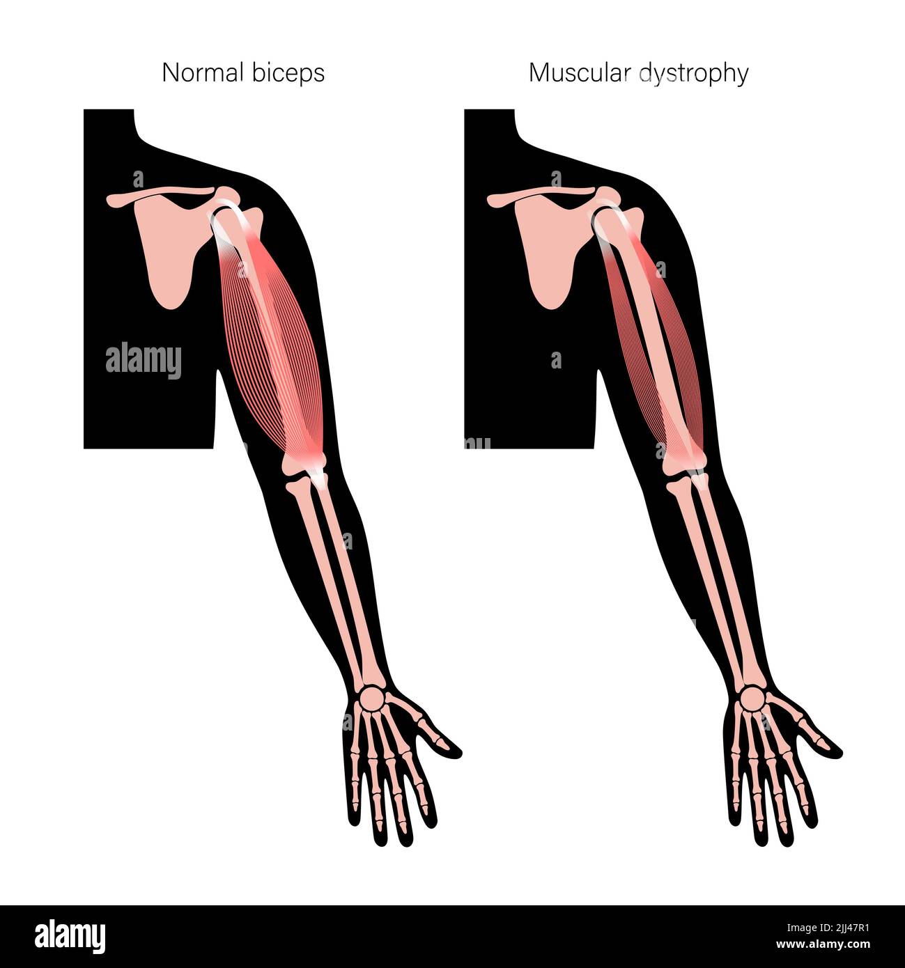 Distrofia Muscular Distal