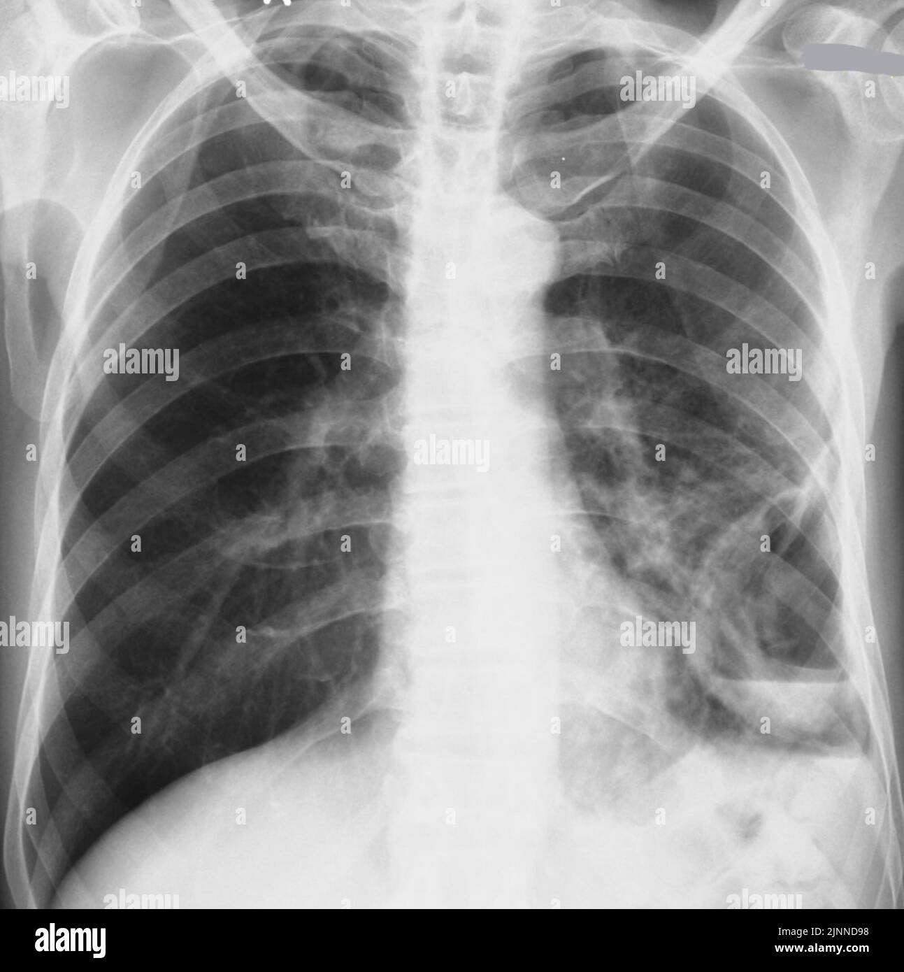 Raio X De Abscesso Pulmonar
