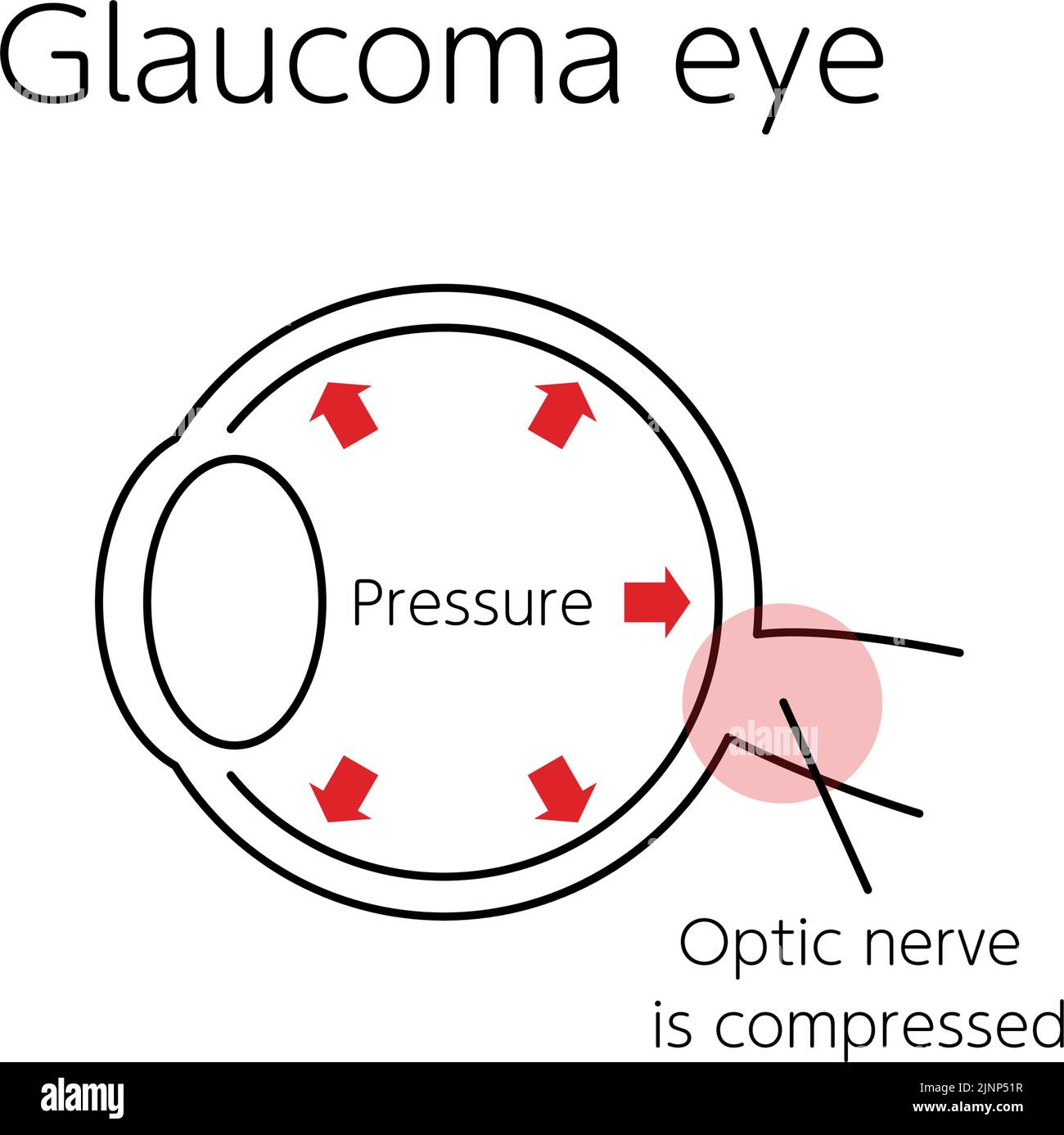 Ilustración De Cómo Funciona El Glaucoma Ojo Del Glaucoma Ilustración