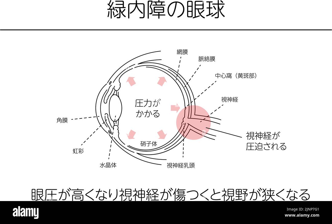 Ilustración Glaucoma Del Ojo Ilustraciones Médicas Traducción