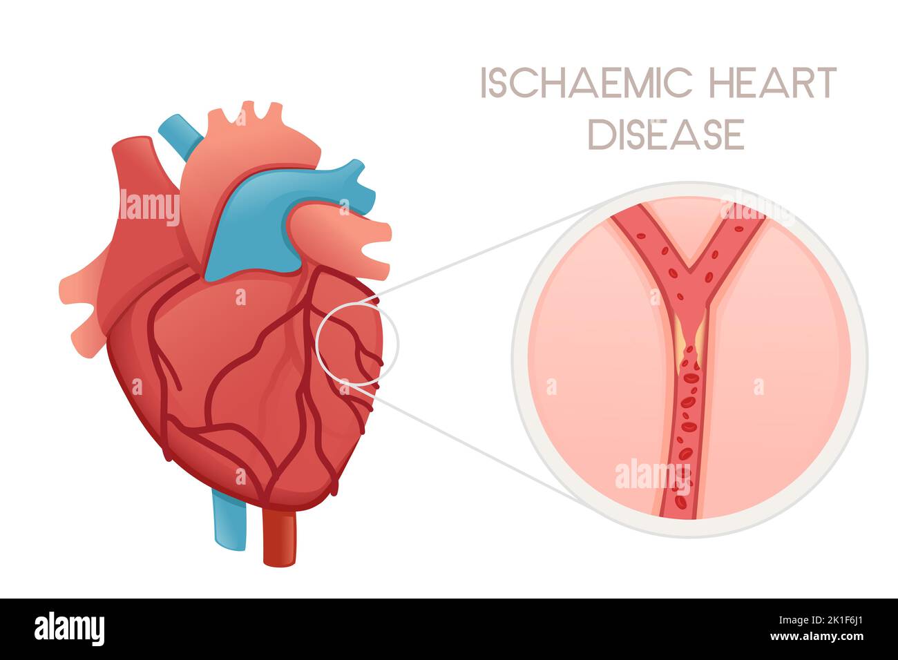 Corazón Humano No Sano Con Enfermedad Isquémica Anatomía Ilustración