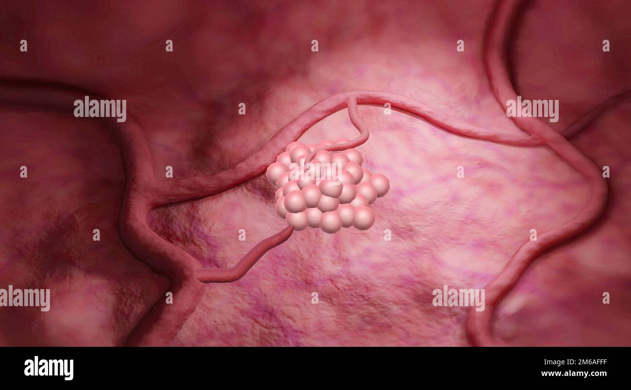 El Cáncer De Pulmón Es Causado Por El Crecimiento Incontrolado De Células Dañinas En Nuestros