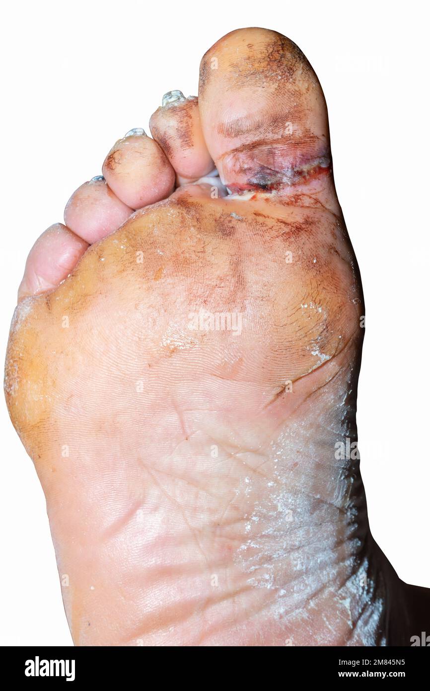 Herida De Laceración