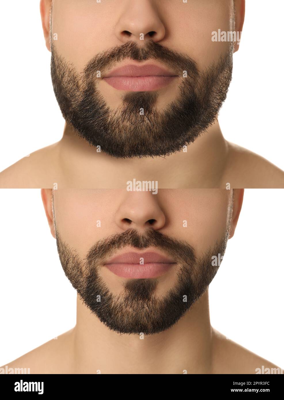 Implante De Menton Masculino Antes Y Despues